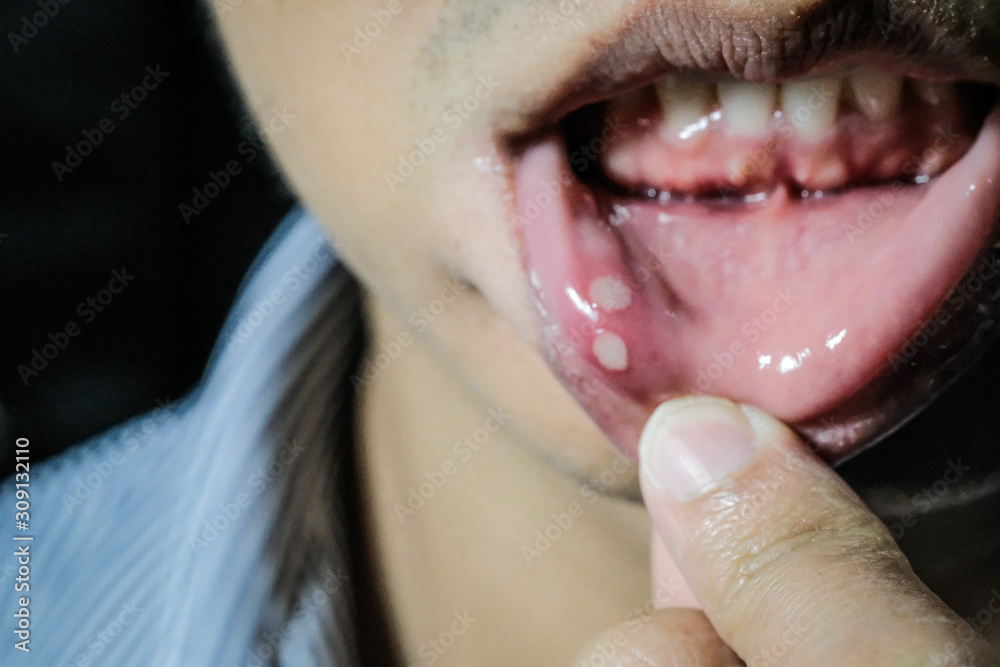 Mouth Ulcers Close Up Of Asian Man With Aphtha On Lip With Copy