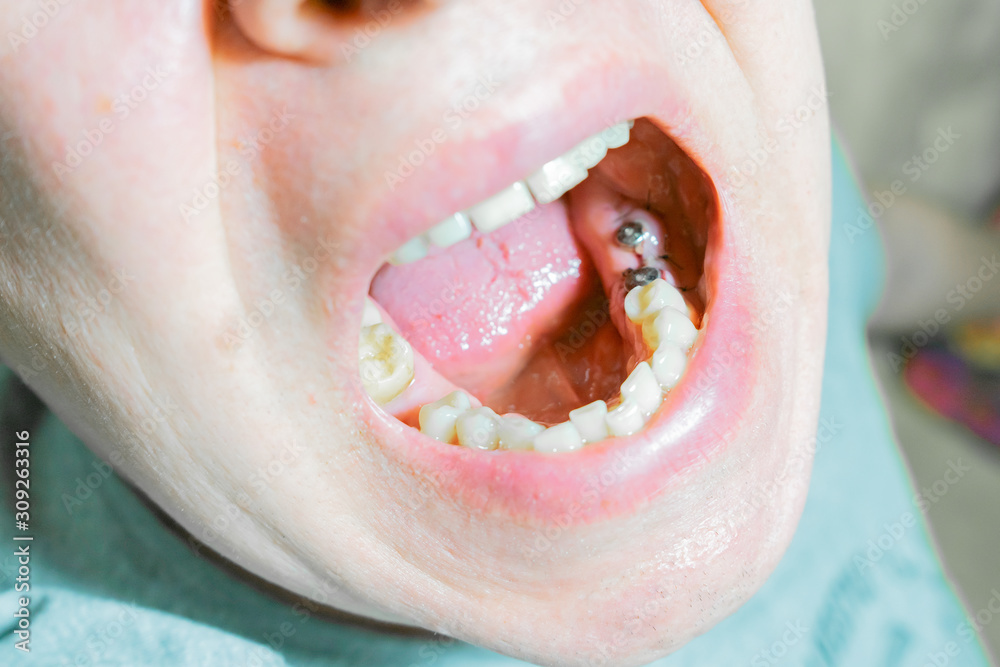 Dental implantation, expansion stage. Dentures, implants in the gums ...