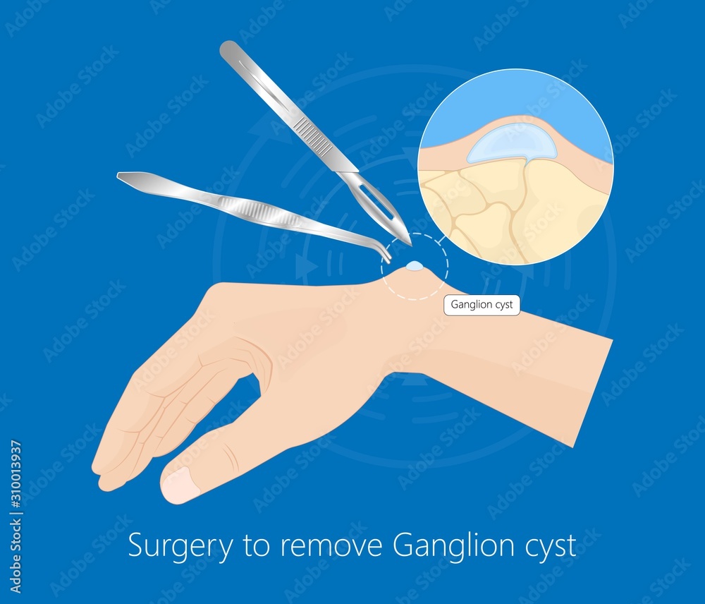 Ganglion cyst disease hand wrist trauma Stock Vector | Adobe Stock