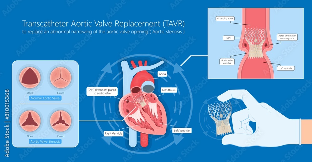 Transcatheter aortic valve replacement (TAVR) minimally invasive surgery Stock Vector | Adobe Stock