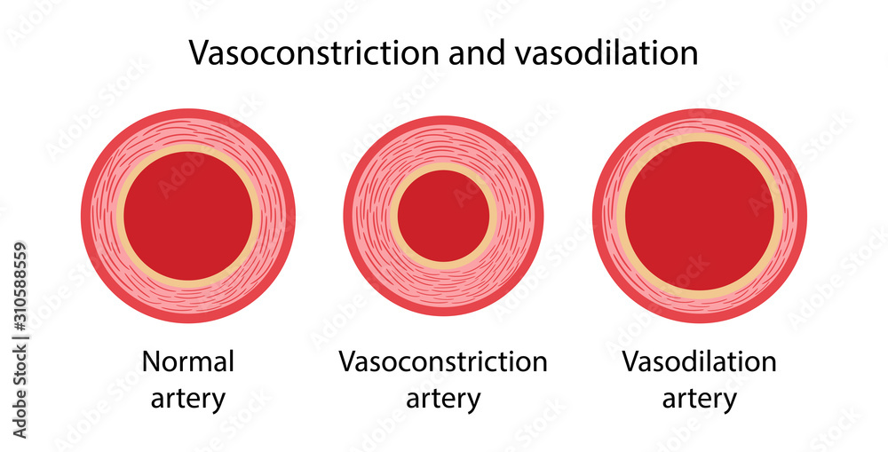 Arterial vasoconstriction and vasodilation. Comparison illustration of ...