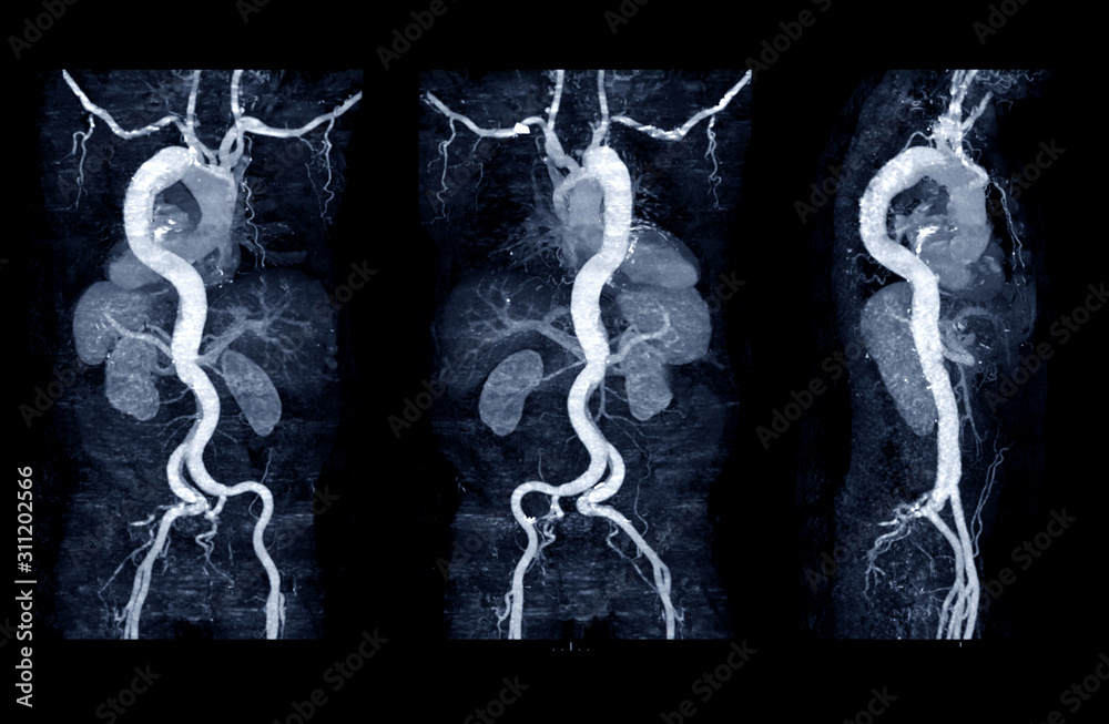 Collection of CTA whoe aorta with curve MPR technique showing abdominal ... Collection of CTA whoe aorta with curve MPR technique showing abdominal ...