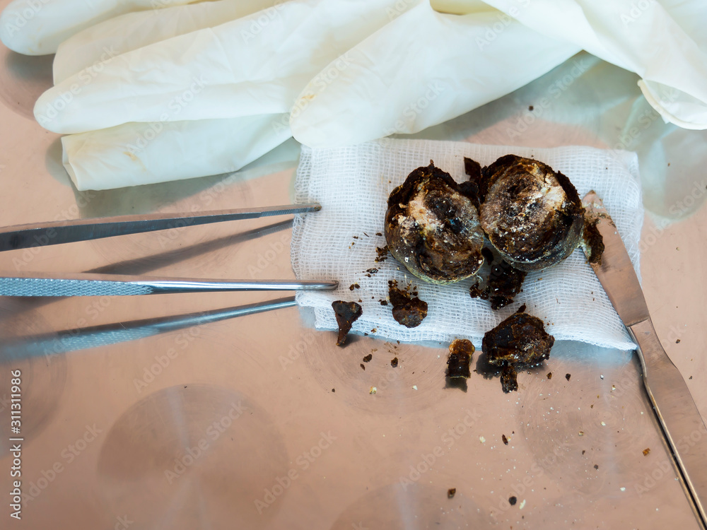 Large crystallized gallstone, cut when viewed. The concrement was ...