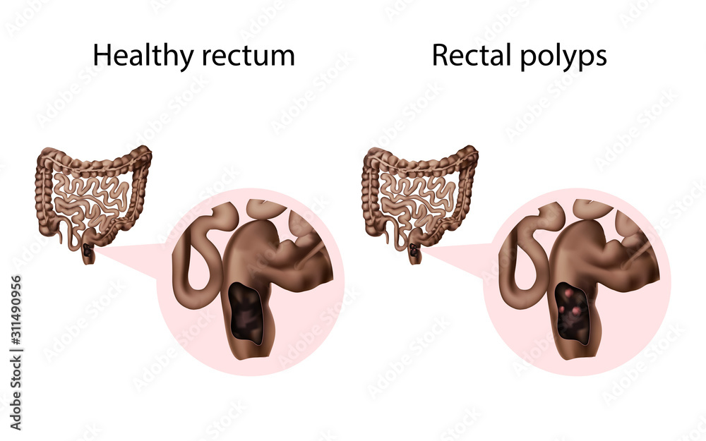 Rectal polyps and healthy organ. Abnormal growth of tissue. Medical ...