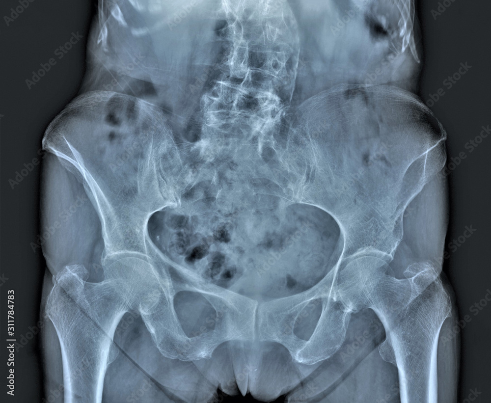 x-ray of the lumbar spine, pelvic bones, sacrum, hip joints Stock Photo ...