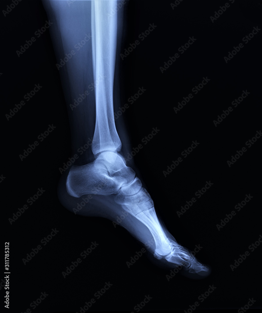 normal radiography of the ankle joint in the lateral projection Stock ...