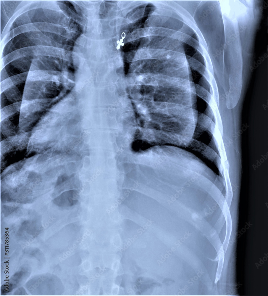 normal radiography of chest organs in direct projection, traumatology ...