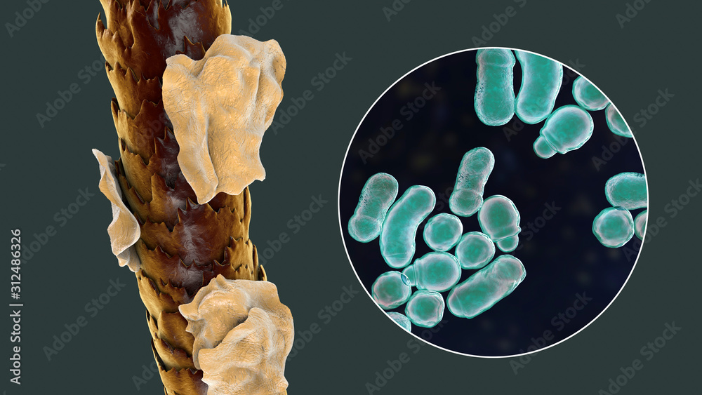 Human hair with dandruff and close-up view of microscopic fungi ...