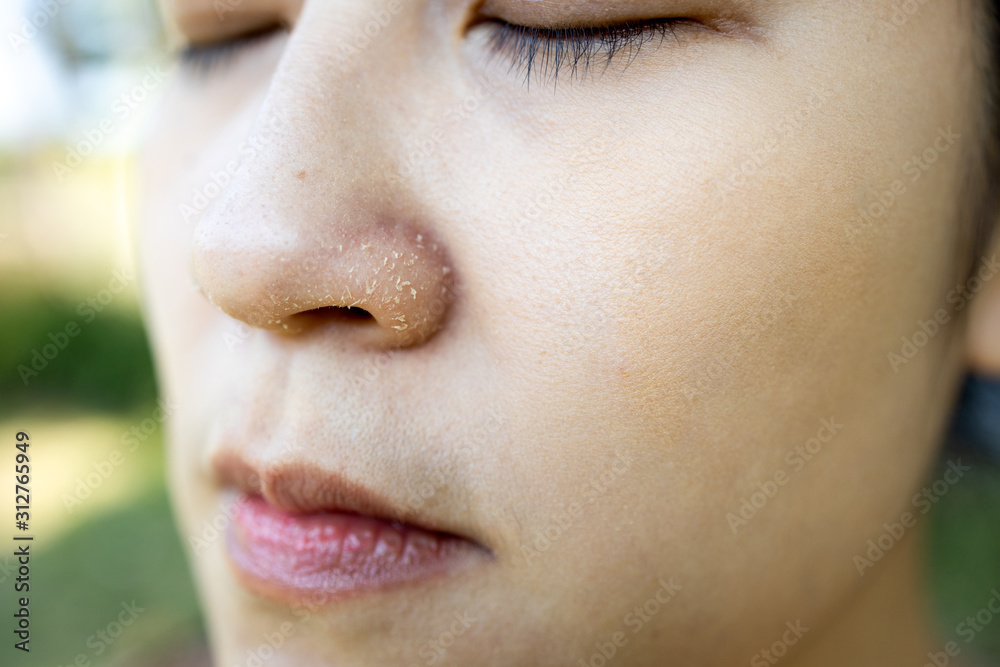Allergic young woman have eczema dry nose on winter season,female ...