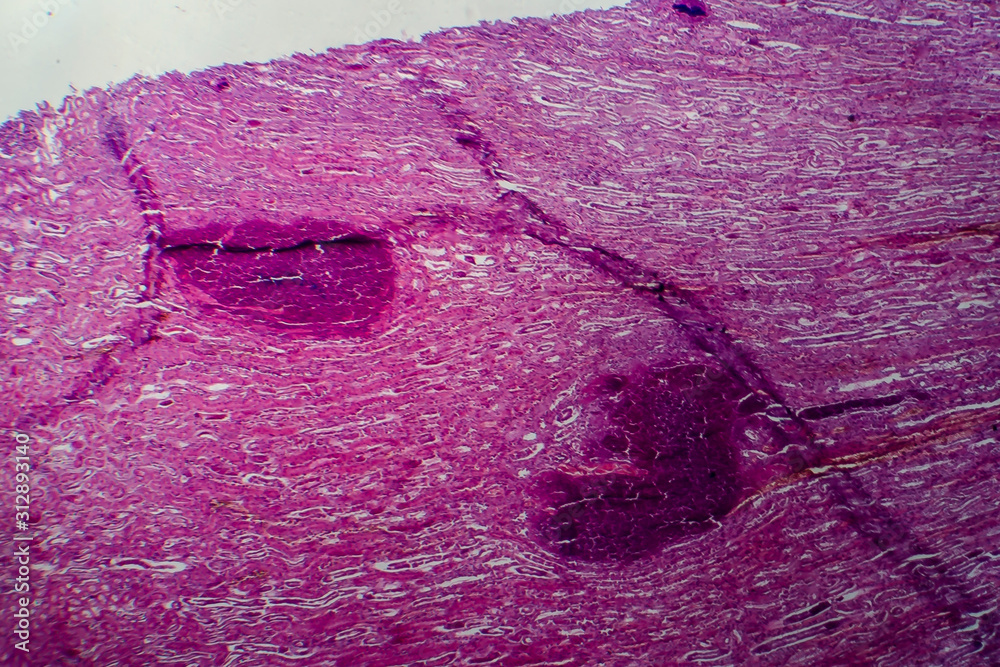 Acute pyelonephritis, light micrograph, photo under microscope Stock ...