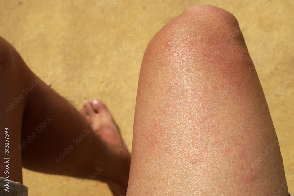 Rash on the legs is a symptom of hives skin caused by dust allergies or ...