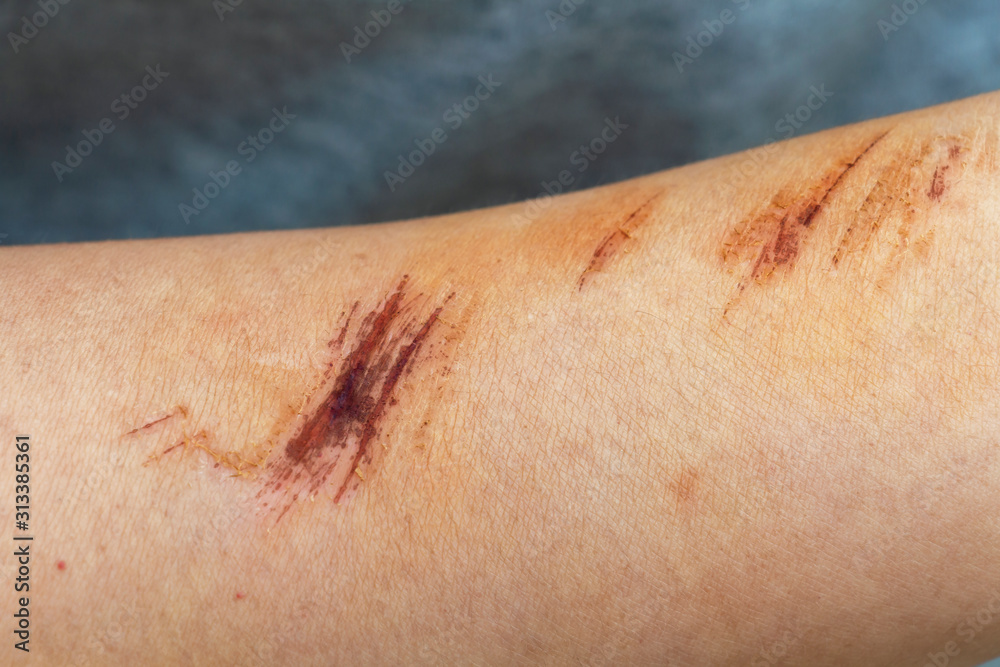 The wound form scabs on hand and arm. The wound happen during woman ...