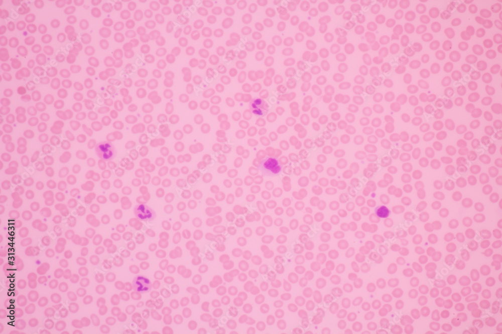 Human blood smear view in microscopy.Complete blood count for treatment ...