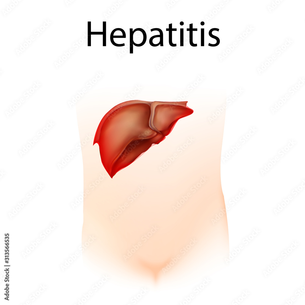 Hepatitis. Liver disease, inflammation. Medical anatomy illustration ...