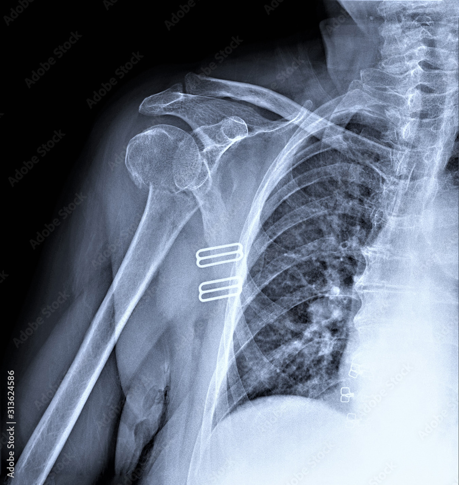 radiography of the shoulder joint in direct projection with a fracture ...