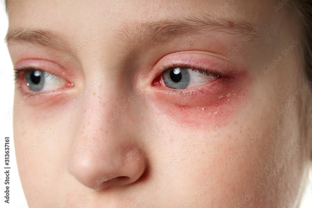 Allergic reaction, skin rash, close view portrait of a girl's face ...