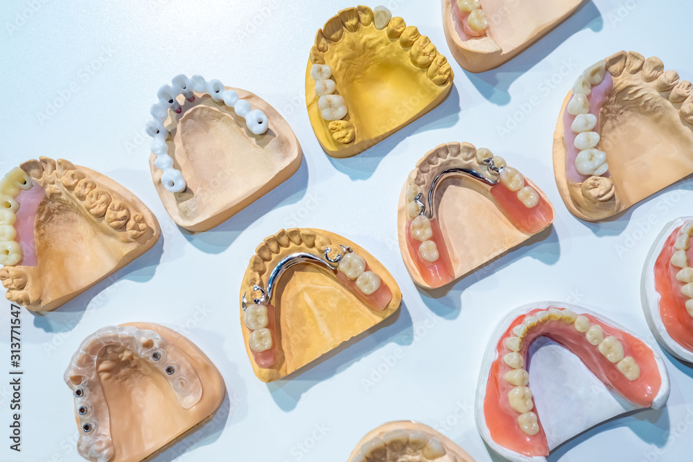 Models of dentures of different types. Visual aid for students of the ...