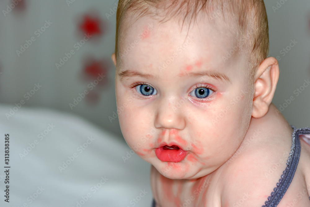 Allergy baby skin dermatitis food. child dermatitis symptom problem ...