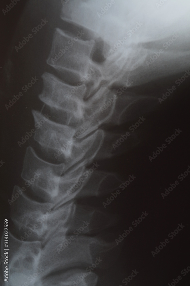 Foto de Stock Magnetic resonance image of human spine. X-ray of the ...