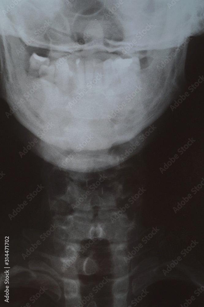 Foto de Stock Magnetic resonance image of cervical spine, Jaw and of ...