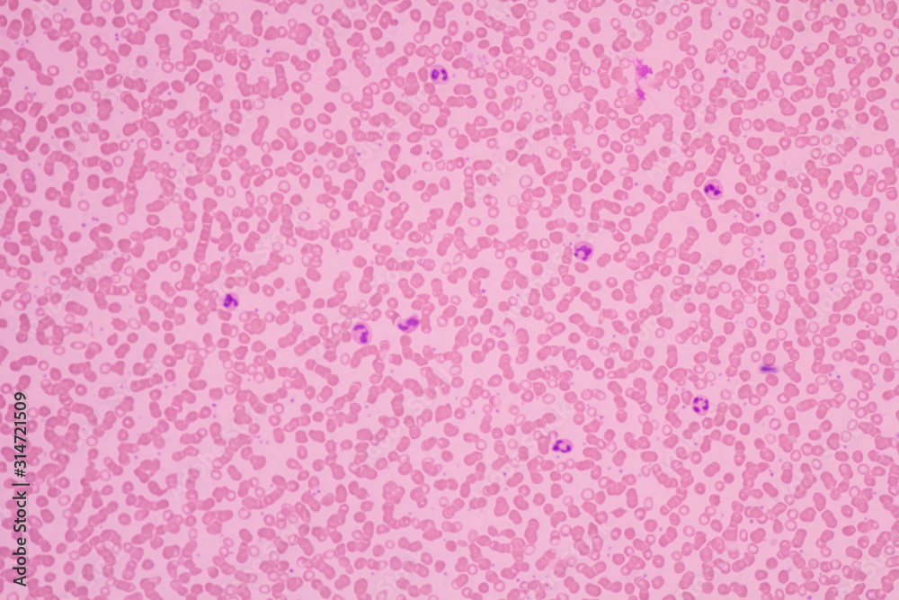 Stock-Foto „Human blood smear view in microscopy.Complete blood count ...