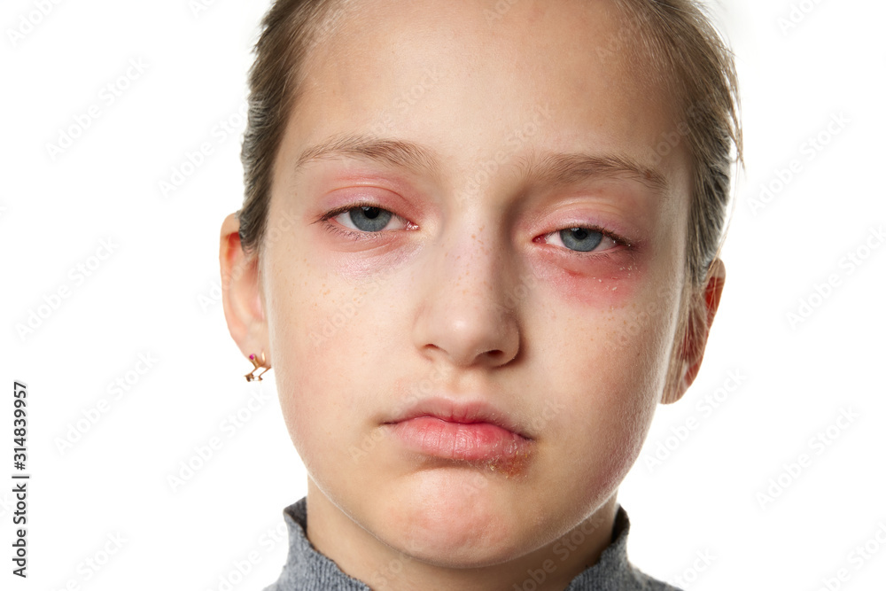 Allergic reaction, skin rash, close view portrait of a girl's face ...