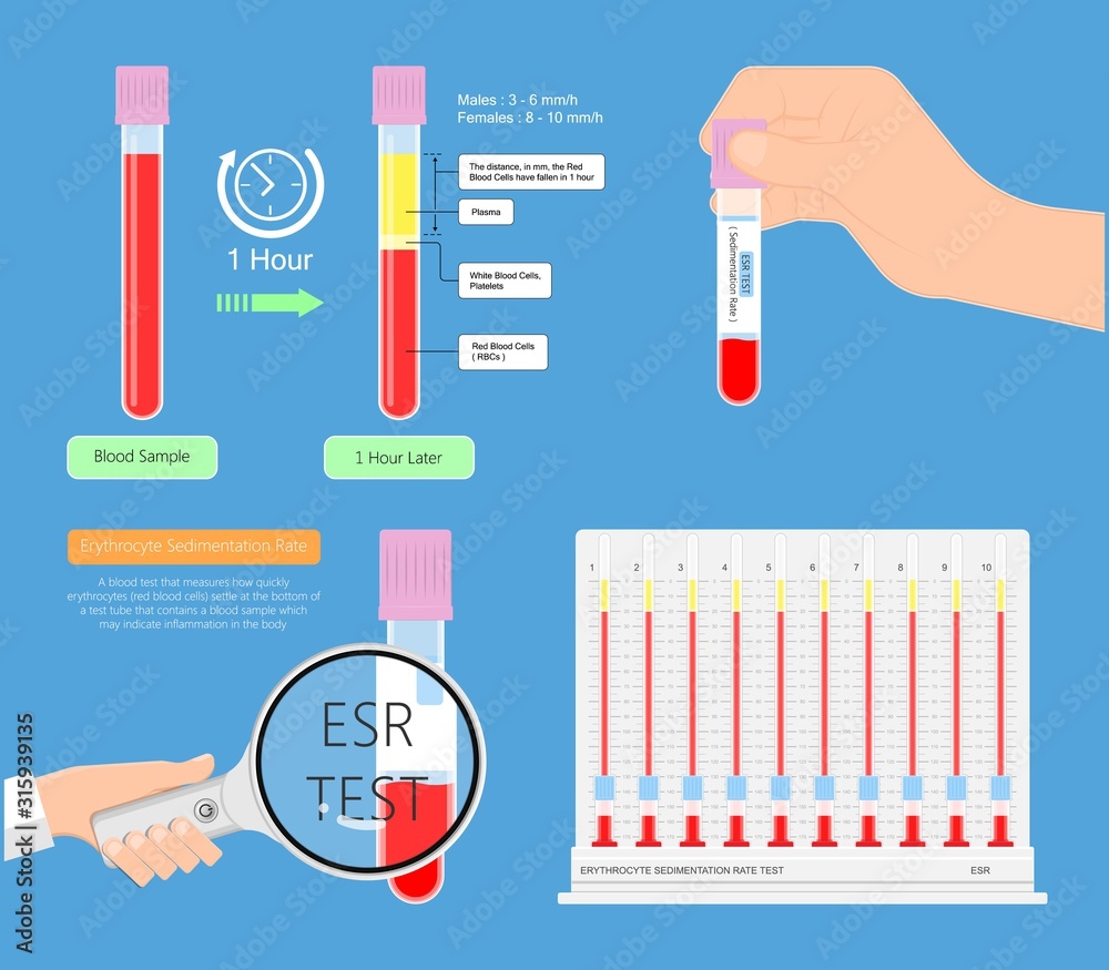 Erythrocyte Sedimentation Rate Test (ESR) Test blood diagnose ...