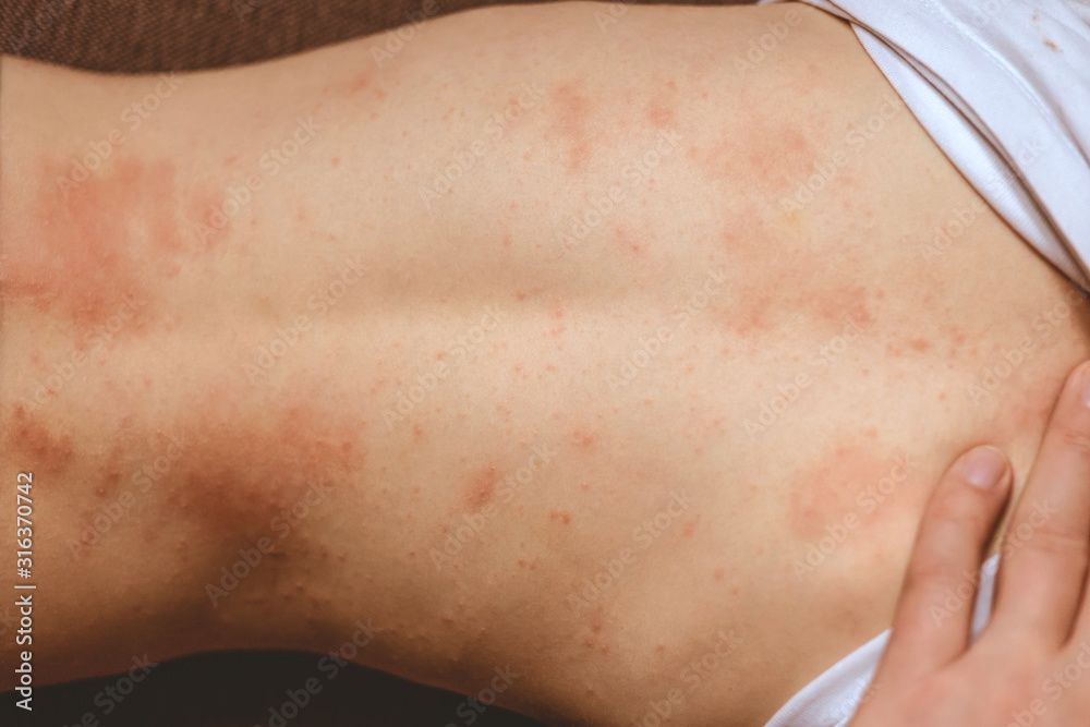 Foto de Stock rash on the child's back. red rash in children of ...