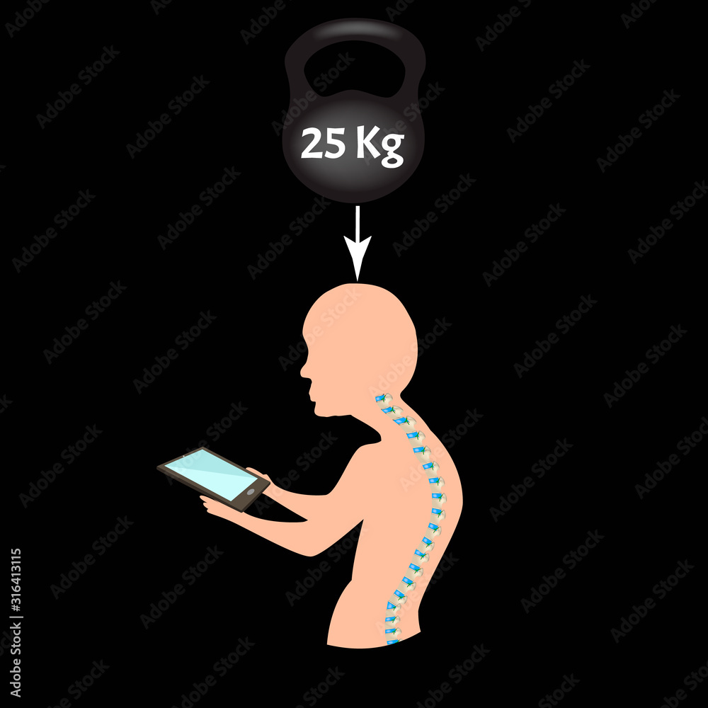 Improper posture symptoms. Text Neck Syndrome. Spinal curvature ...