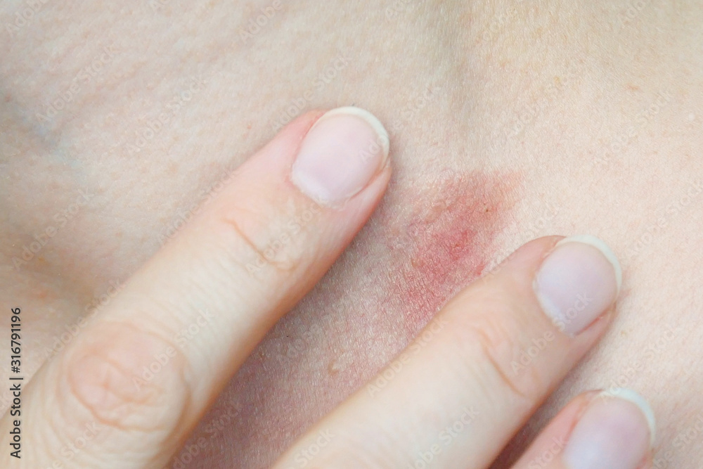 Foto de Stock skin rash treatment on woman neck. Shingles, Disease ...