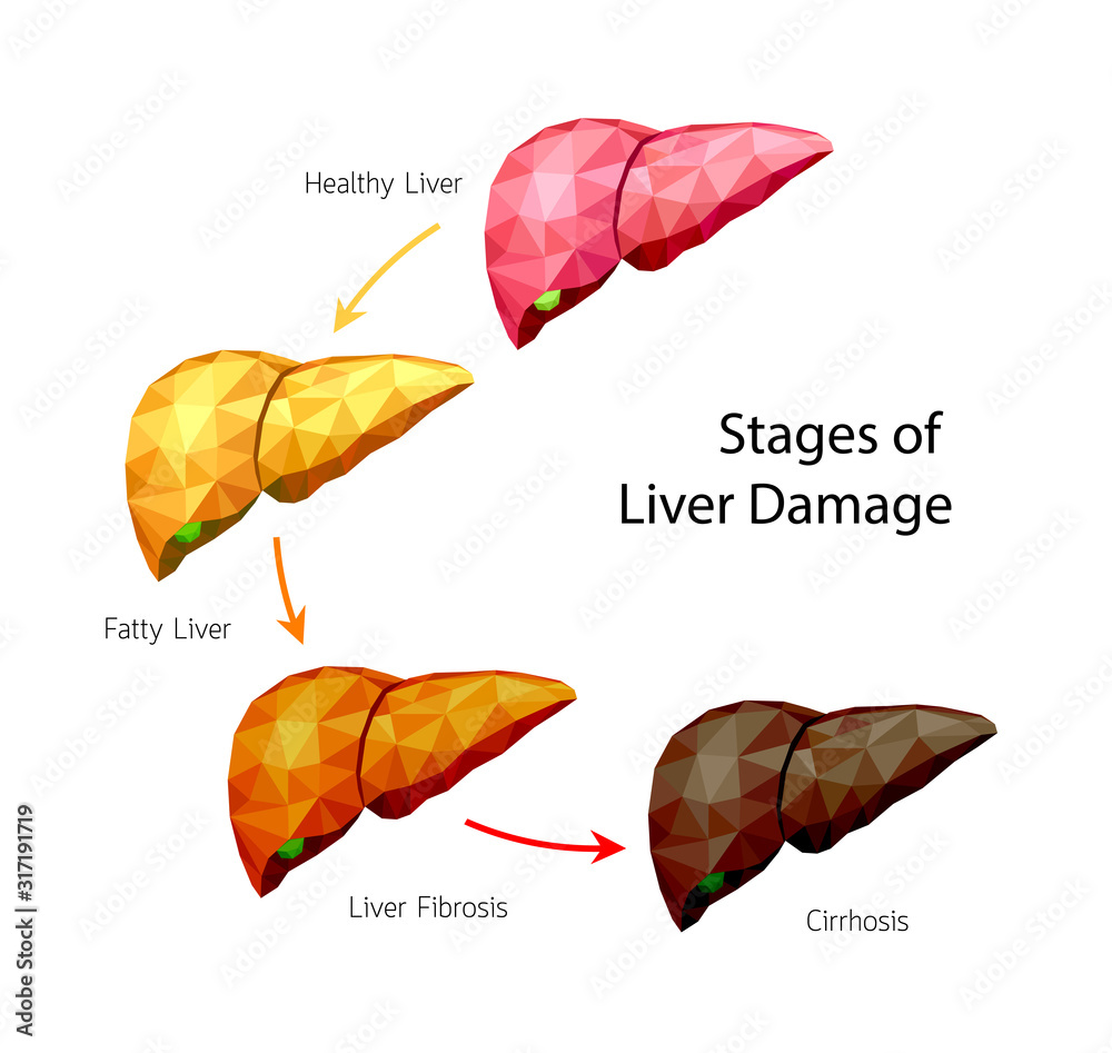 Stages of liver damage, polygonal art style. Liver Disease. Healthy ...
