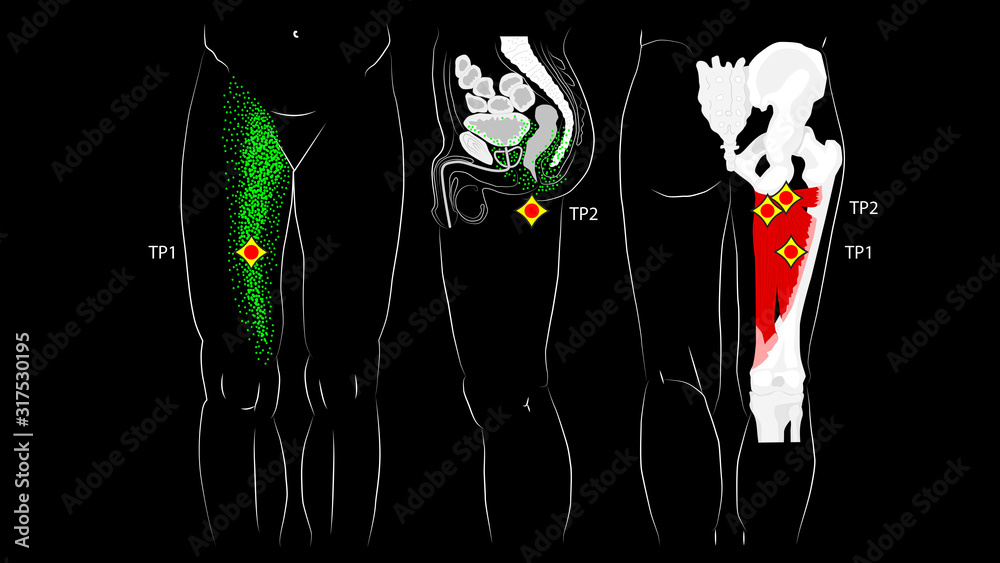 Adductor muscles of the hip. Trigger points and reflected pain on the ...