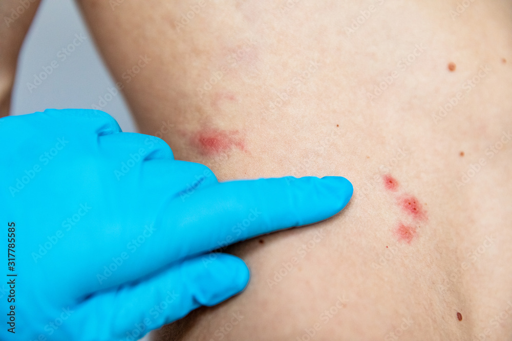 Herpes on body. Skin disease. Professional doctor examining skin of a patient. Stock Photo ...