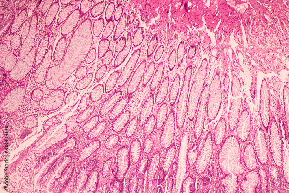 View in microscopic of ductal cell carcinoma, adenonocarcinoma from ...