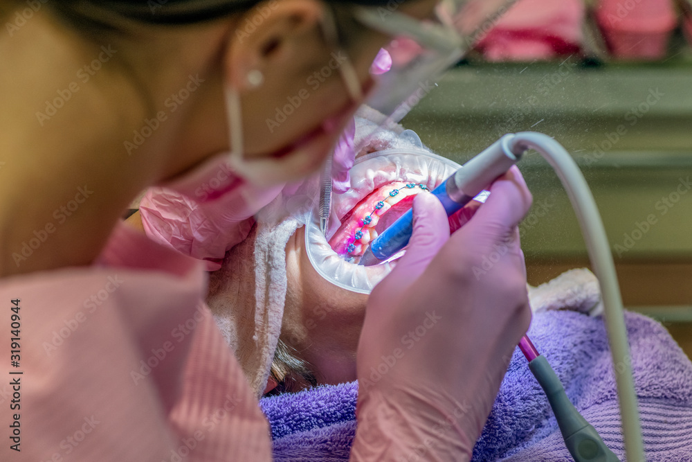 Patient with braces and a cheek retractor in a dental clinic Stock ...