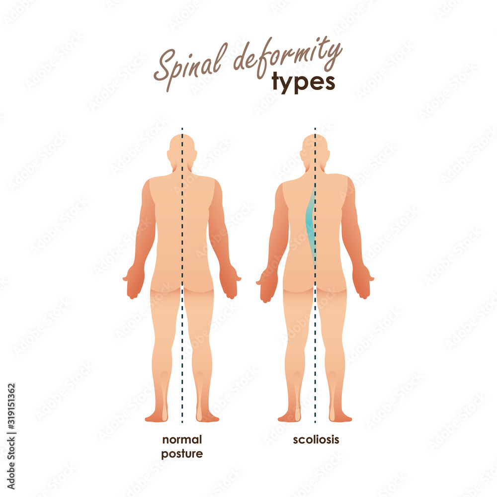 Spinal deformity types. Diseases of the spine.scoliosis and normal ...