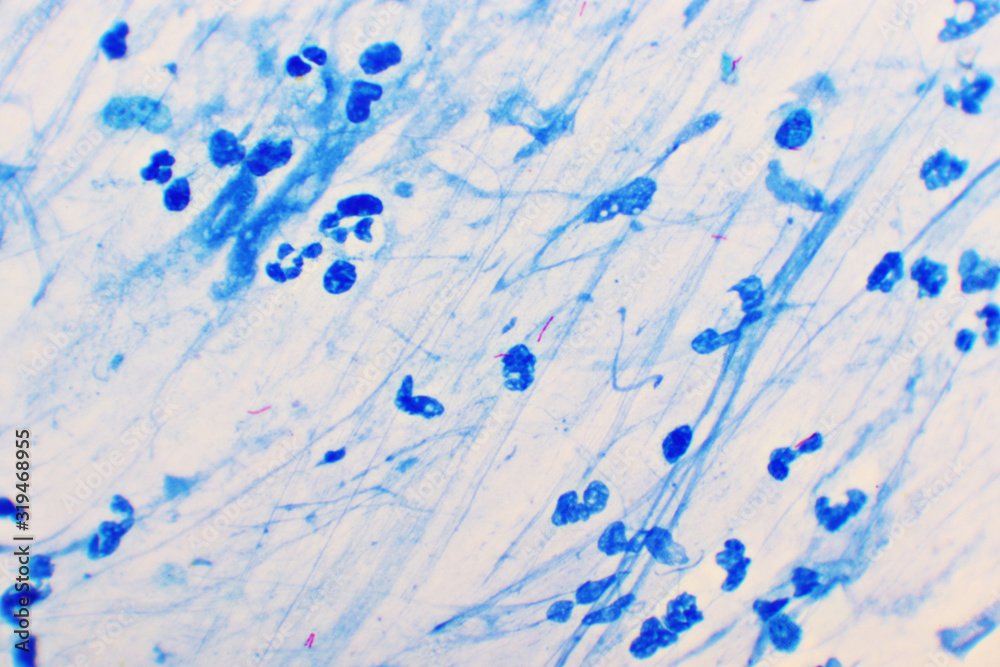 Foto Mycobacterium tuberculosis positive (small red rod) in sputum ...