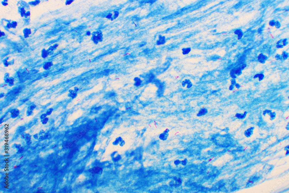 Mycobacterium tuberculosis positive (small red rod) in sputum smear ...