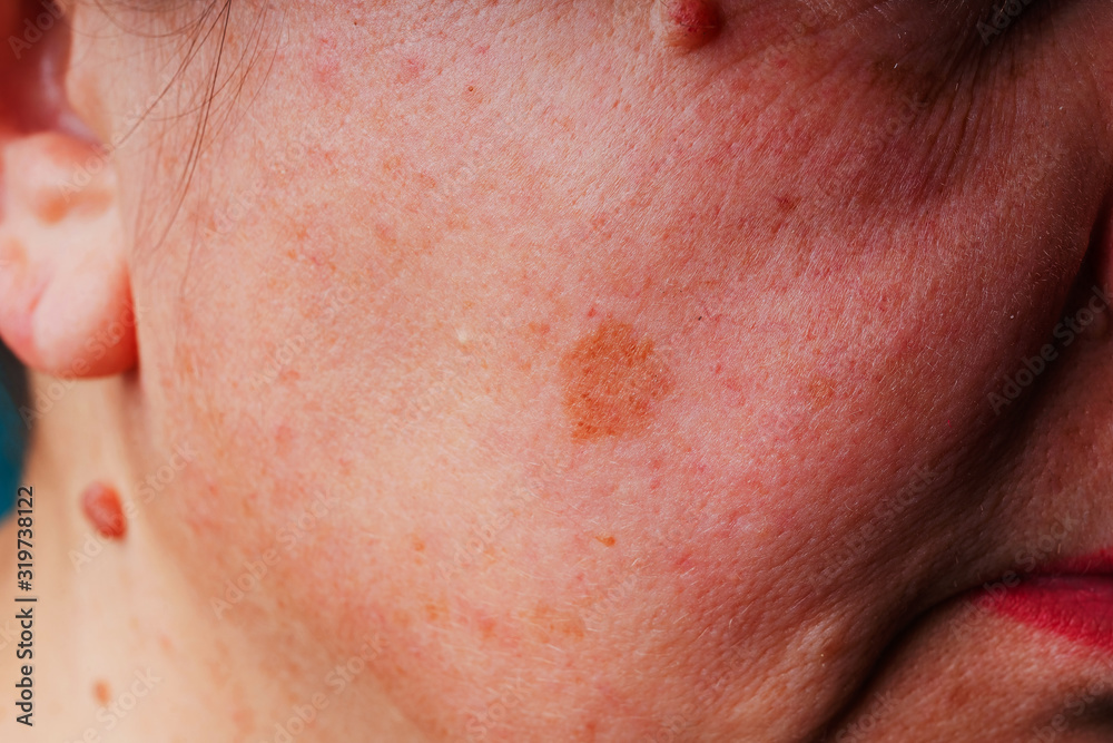 Age spots, moles and freckles on the face close-up. Spots on the skin ...