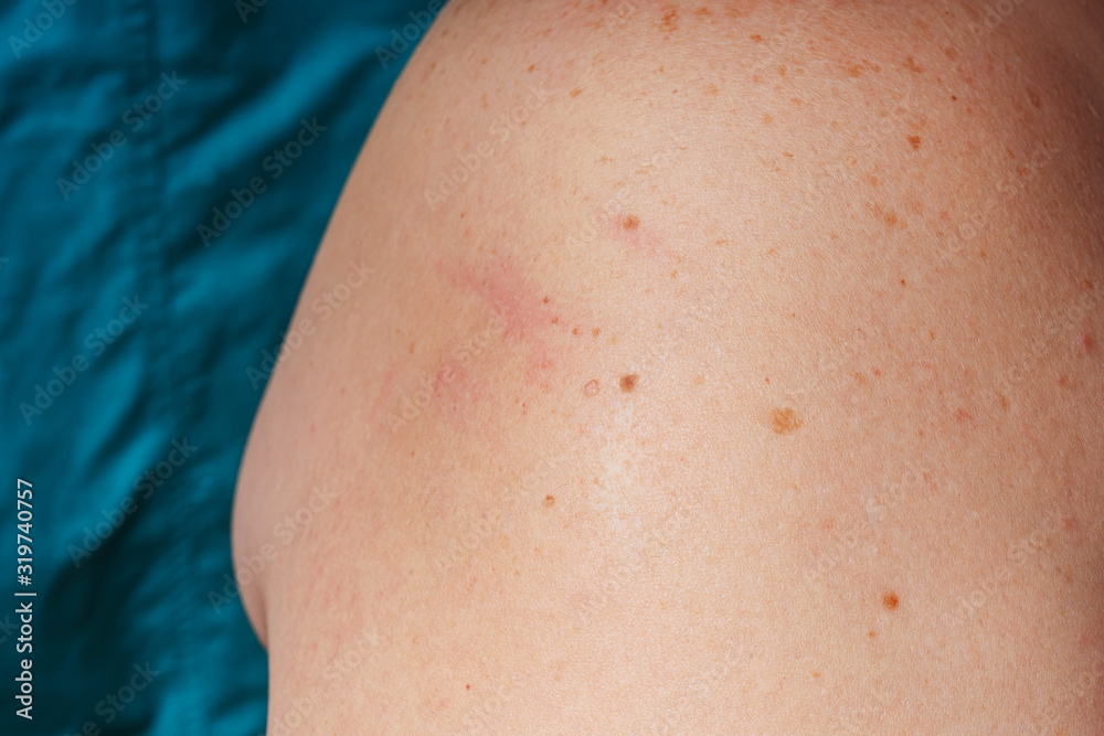 Foto de Stock Age spots, moles and freckles on the shoulders and back ...