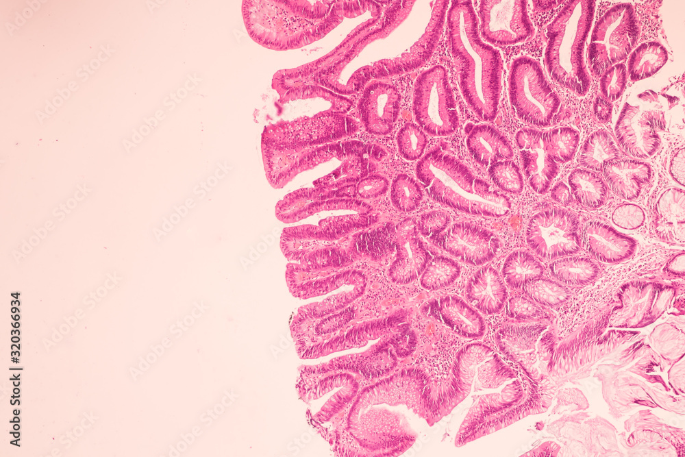 View in microscopic of ductal cell carcinoma, adenonocarcinoma from ...
