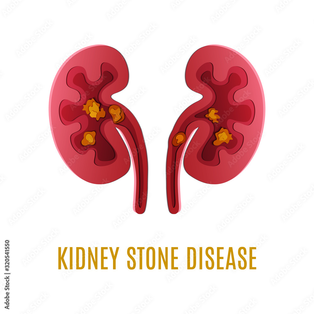 Kidney stone disease awareness poster with kidneys made in paper cut ...