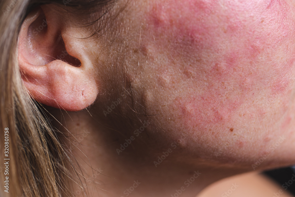 Real skin Biorevitalization. Traces of biorevitalization injections on ...