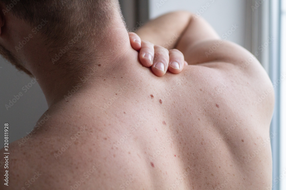 Checking benign moles. Close up detail of the bare skin on a man back ...