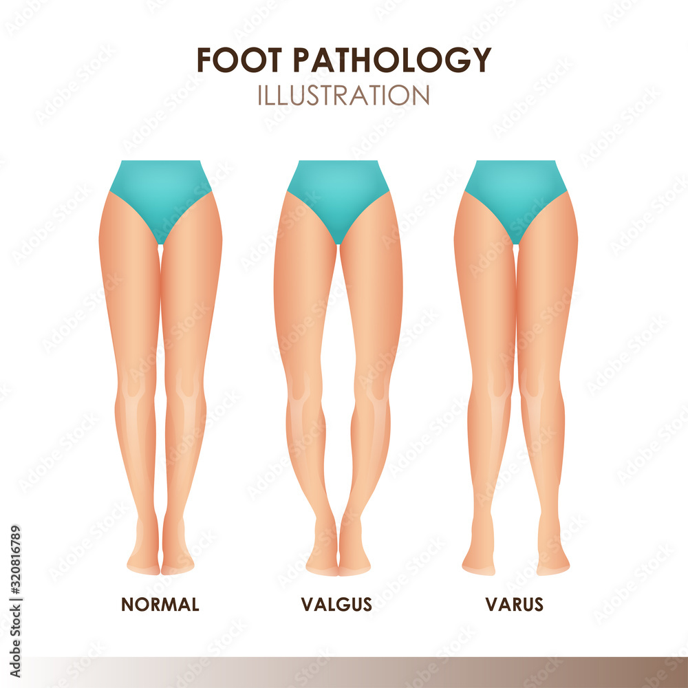 Foot pathology illustration. Normal, valgus, varus. Legs disease, deformation Stock Vector ...