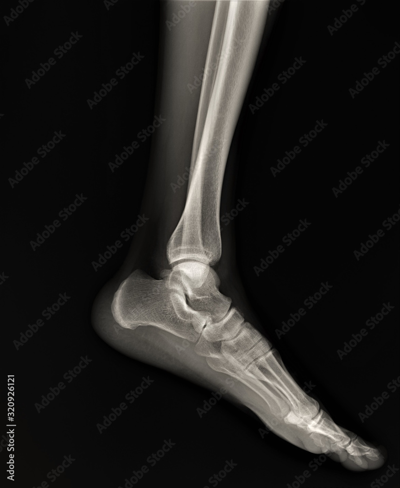 normal radiography of the ankle joint in the lateral projection Stock ...