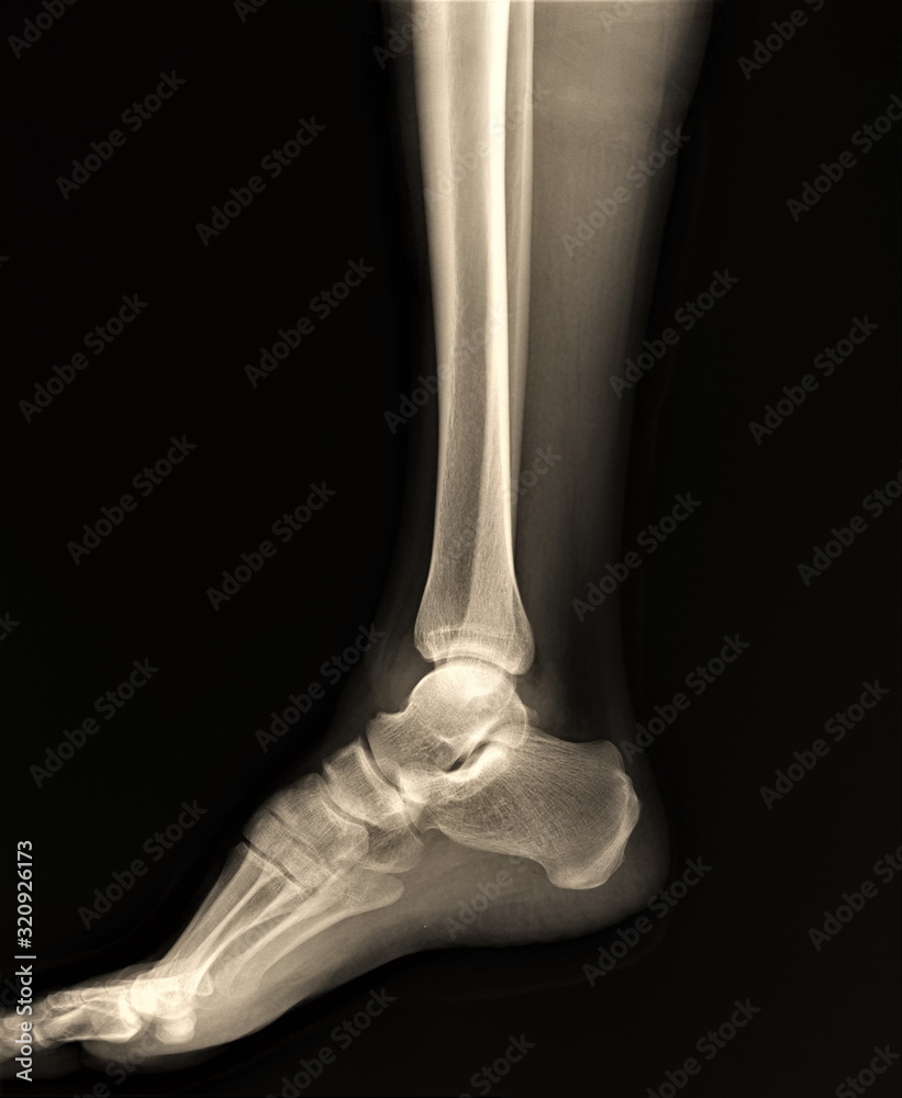 normal radiography of the ankle joint in the lateral projection Stock ...