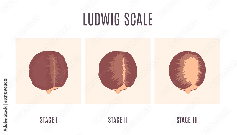 Female-pattern hair loss by Ludwig scale. 3 stages of baldness in women ...