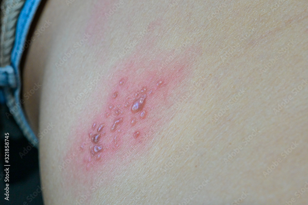 blisters caused by shingles on skin, herpes zoster Stock Photo | Adobe ...