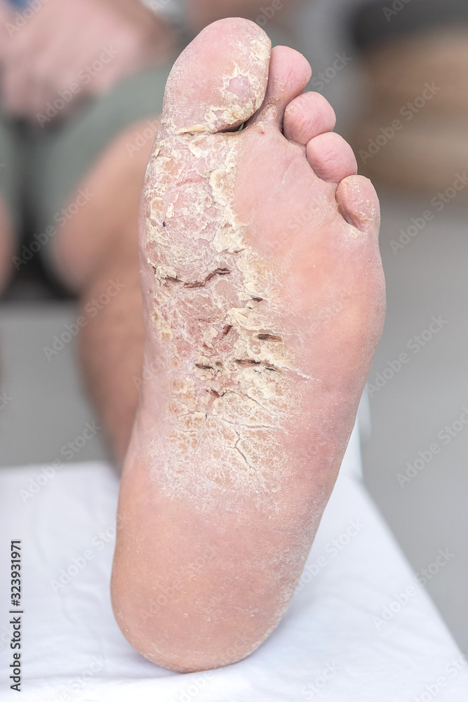 Hautkrankheit, Atiopischer Winterfuß, Fußekzem, Hautekzem, Dermatitis ...